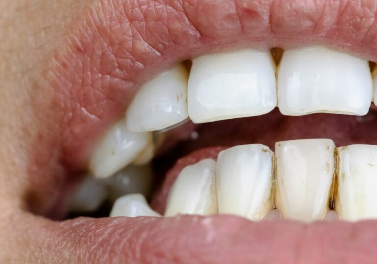 Why Do My Teeth Stain So Easily? (Influencing Factors)