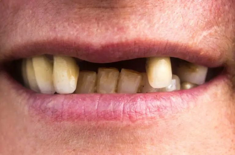 Why Cancer Patients Lose Teeth: Understanding the Connection