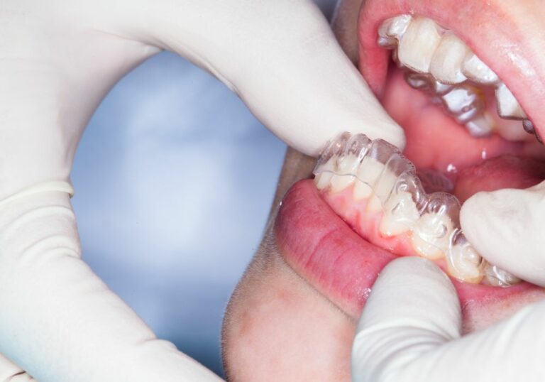 Can Your Teeth Shift Even If You Wear Your Retainer? Exploring the ...