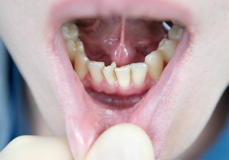 What Is The Best Treatment for Crowded Teeth? (5 Common Orthodontic ...