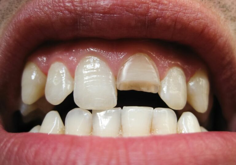 Can Permanent Teeth Break? (Trigger factures, Treatments & Prevention)
