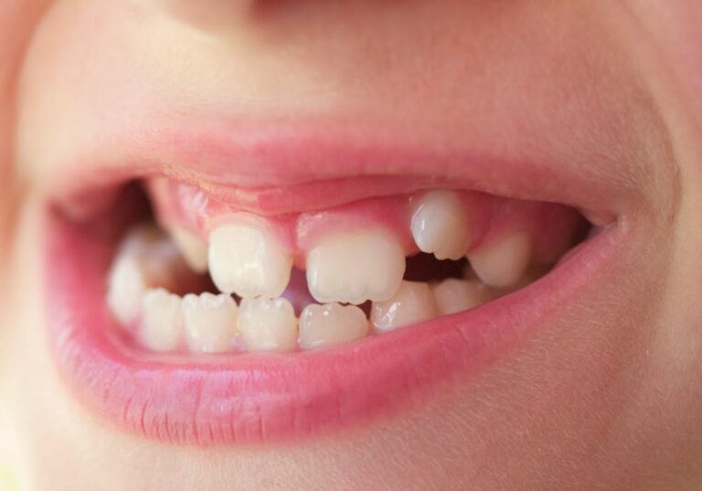 Why do my bottom teeth still look like baby teeth? (Explained)