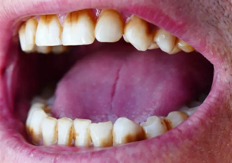 Can Dentists Tell If You Vape By Looking At Your Teeth? (Signs Of ...