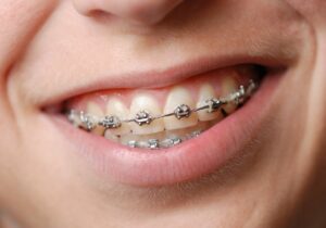 Why Do All My Teeth Hurt After Braces? (An In-Depth Guide)
