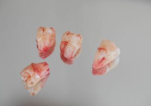 Can You Feel a Blood Clot Dislodge in Wisdom Tooth? Explained