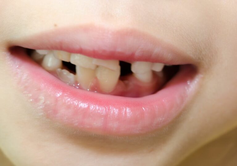 Why Is My Child's Tooth Not Growing Back? (Reasons & Treatments)