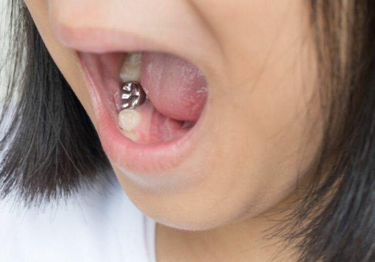 Why Silver Front Teeth? (History & Meaning)