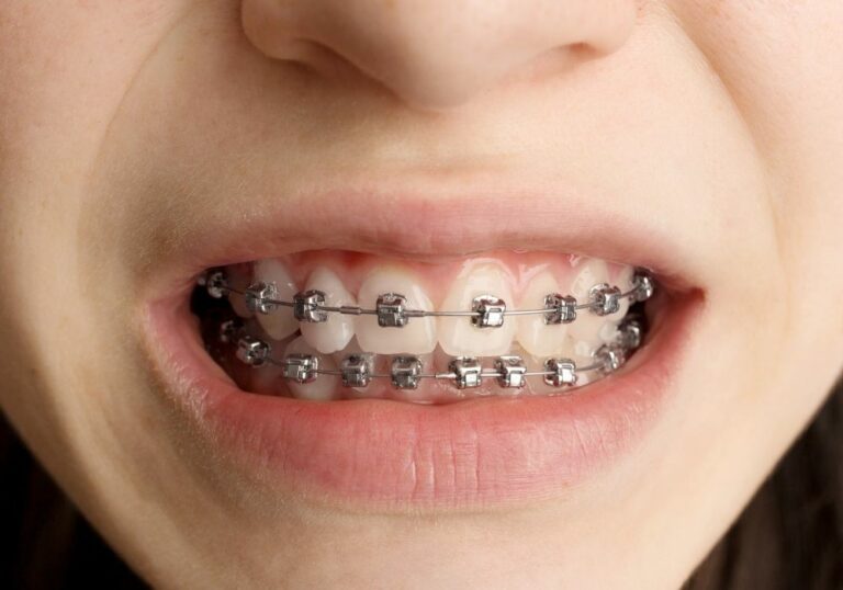 Why Is My Teeth Popping With Braces? (Causes & What To Do)