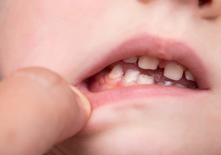 Why Is My Gum Swollen In One Spot? (Causes & treatments)