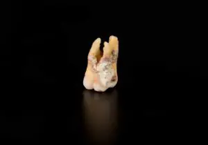 Why Does a Rotten Tooth Smell? (Causes & Consequences)