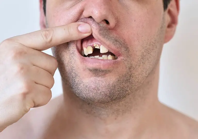 How Long Can A Broken Tooth Be Left? (What To Do With Broken Teeth)