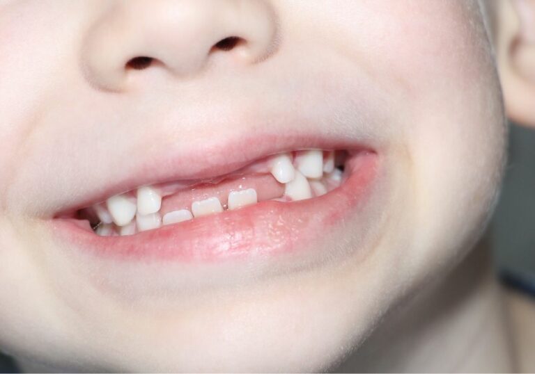 Why Does My Baby Have Black Stains on Teeth? (Causes and Solutions)