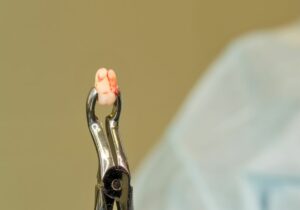 Can You Feel a Blood Clot Dislodge in Wisdom Tooth? Explained