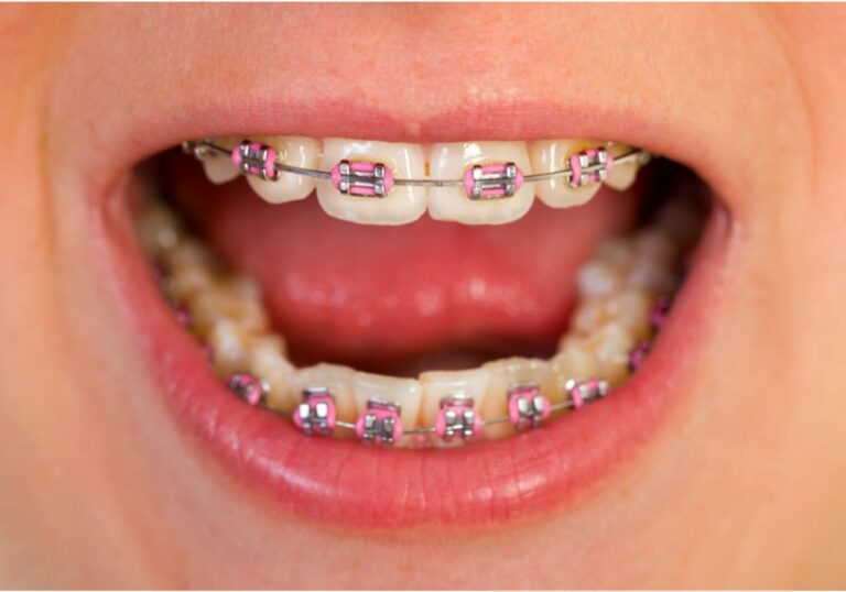 Why Do All My Teeth Hurt After Braces? (An In-Depth Guide)