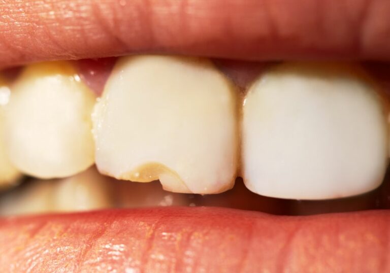 Why Did A Piece Of My Tooth Break Off? (Causes & Treatment)