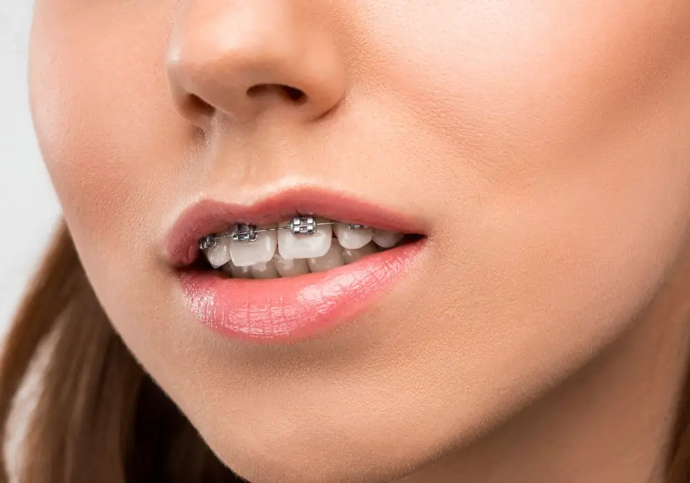 Can Teeth Grinding Cause Overbite Causes Influence And Treatments