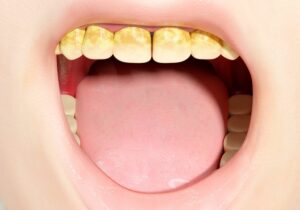 Can Tooth Calcification Be Reversed? (A Comprehensive Guide)