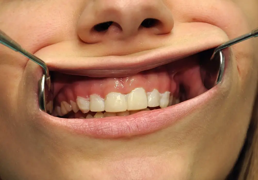 Why Do The Bottom Of My Teeth Feel Fuzzy Causes And Tips