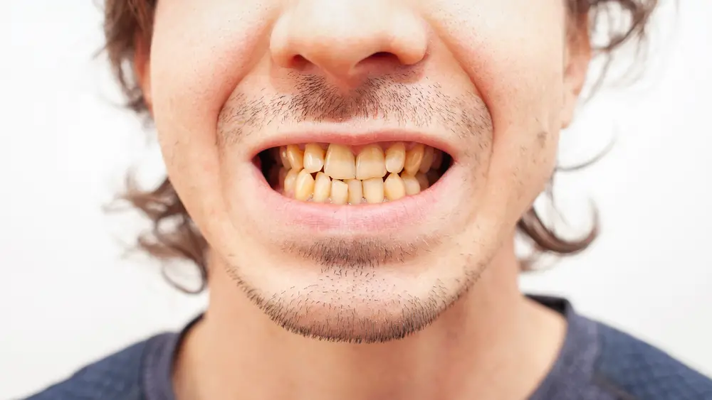 Why Is White Stuff Forming On My Teeth? (How To Remove Plaque)