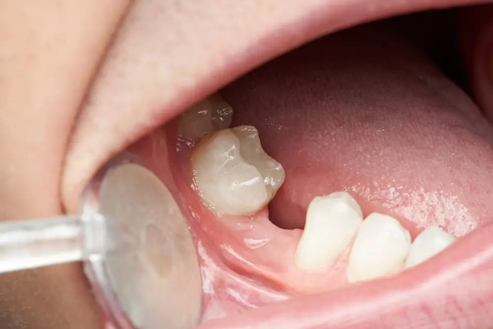 Why Do I Have Porous Teeth? (Identification & Treatment)