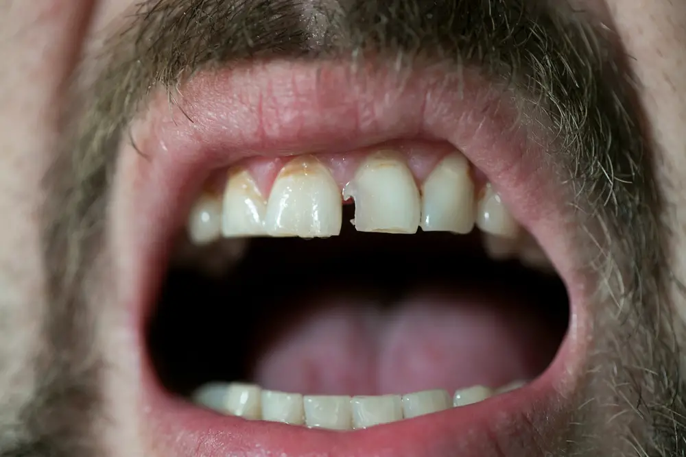 Why You Shouldn't Ignore A Chipped Tooth? (Causes & Treatments)