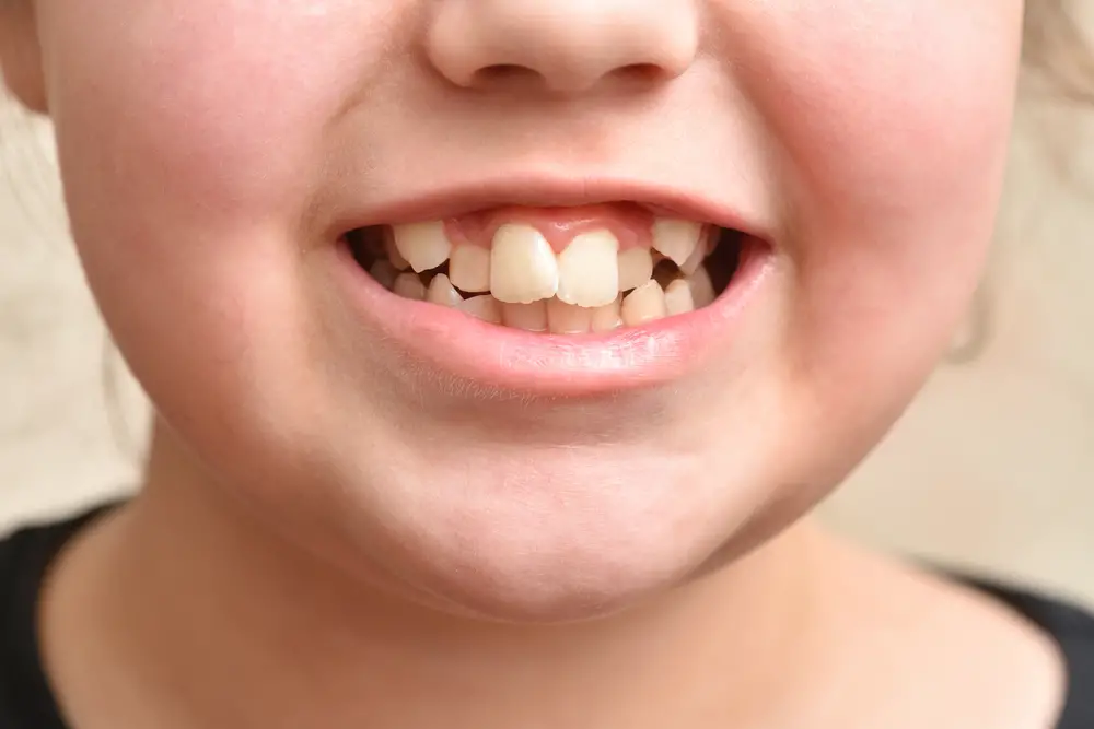 Why Did Humans Evolve Crooked Teeth? (Teeth Evolution Explained) Why Did Humans Evolve Crooked Teeth? (Teeth Evolution Explained)
