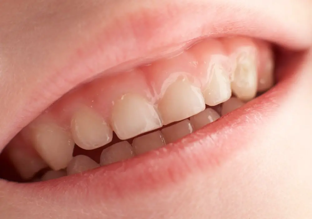 Why Are My Upper Front Teeth Bigger? (Causes & Treatment)