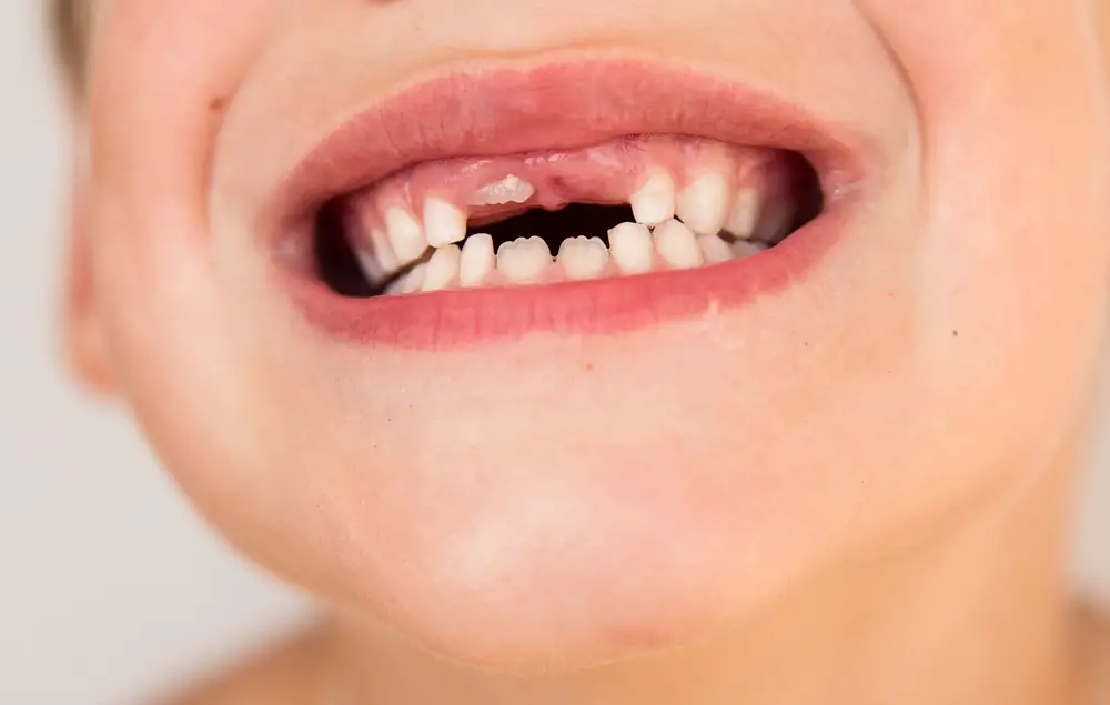 Cleidocranial Dysplasia Teeth