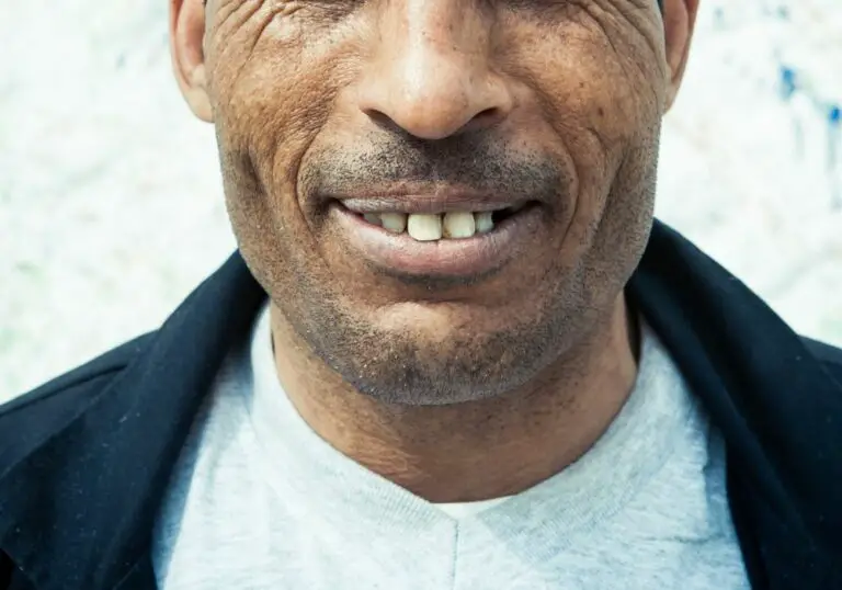 Do Buck Teeth Go Away? Everything You Need to Know