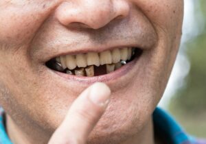 What Happens When Teeth Turn Black: Causes and Treatment