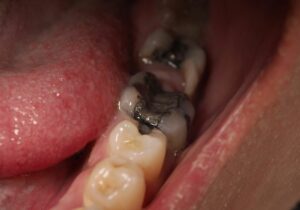 Are Black Teeth Serious? Causes and Treatment Options