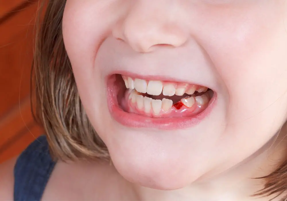 How Many Is a Baby Tooth? Your Guide to Understanding Your Child's ...