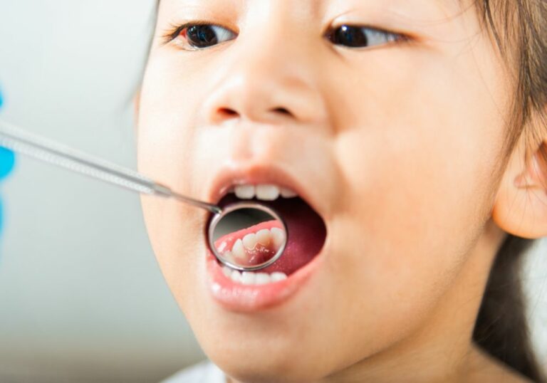 What Happens When a Cavity is in Between Two Teeth? Explained