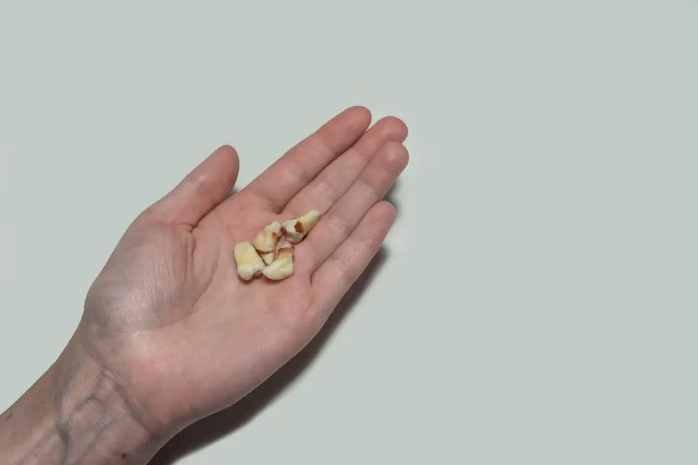 Is 4 Wisdom Teeth Considered a Lot? Explained by a Friendly Dentist