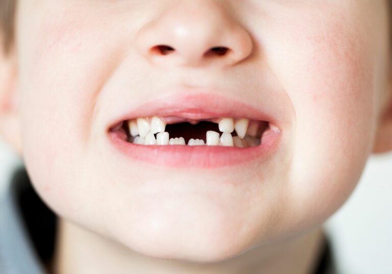 When Do Teeth Fall Out? A Helpful Chart for Parents