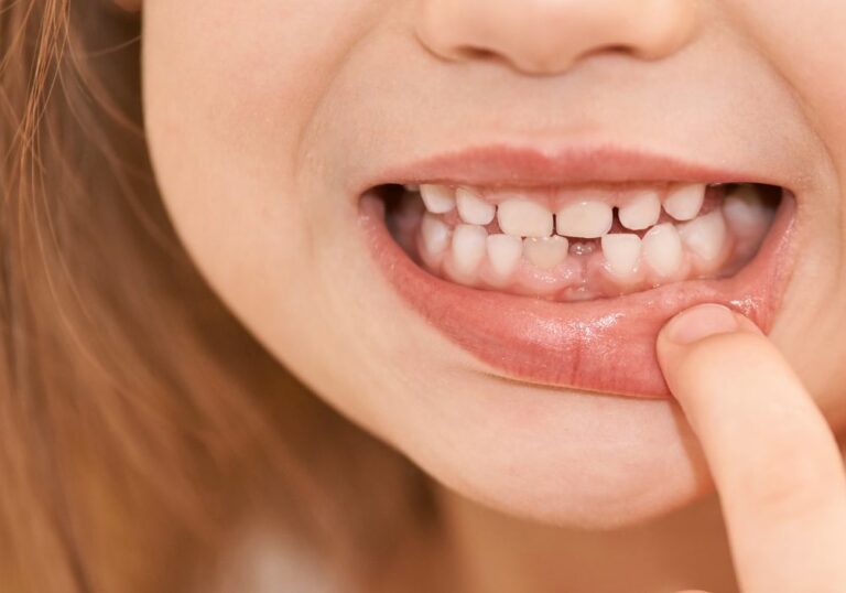 Fixing the Gap Between Teeth Naturally: What You Need to Know
