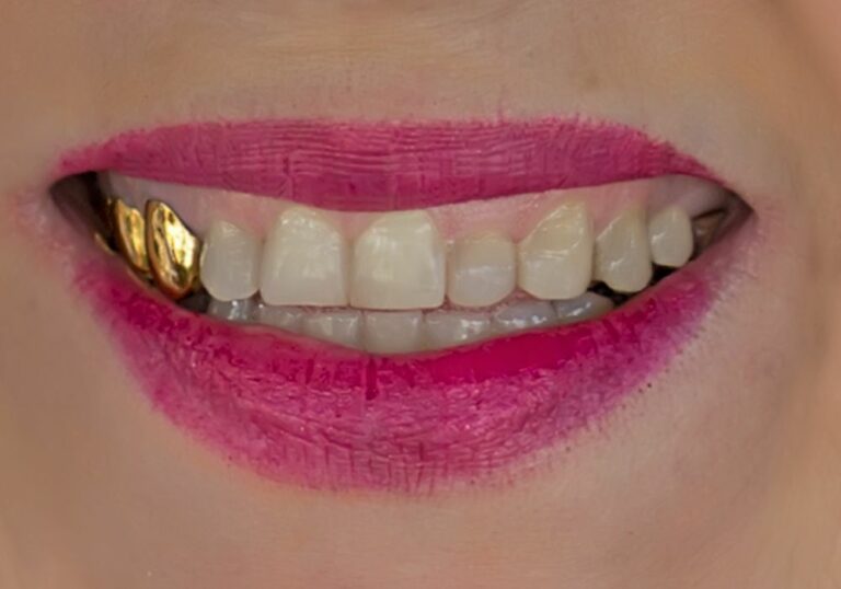 How a Gold Tooth is Made: A Brief Overview