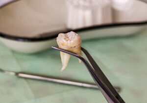 When Do They Use Stitches for Wisdom Teeth Extraction?