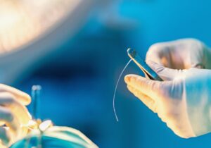 When Do They Use Stitches for Wisdom Teeth Extraction?