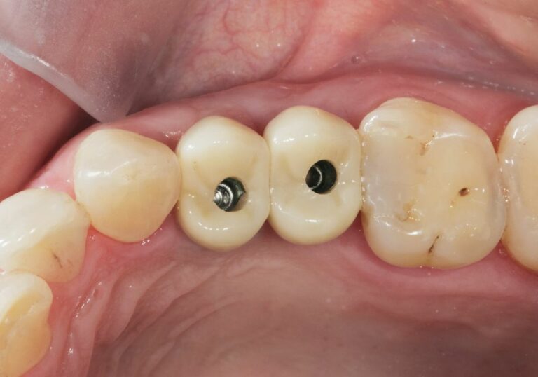 Covering Missing Teeth: Tips While Waiting for Implant