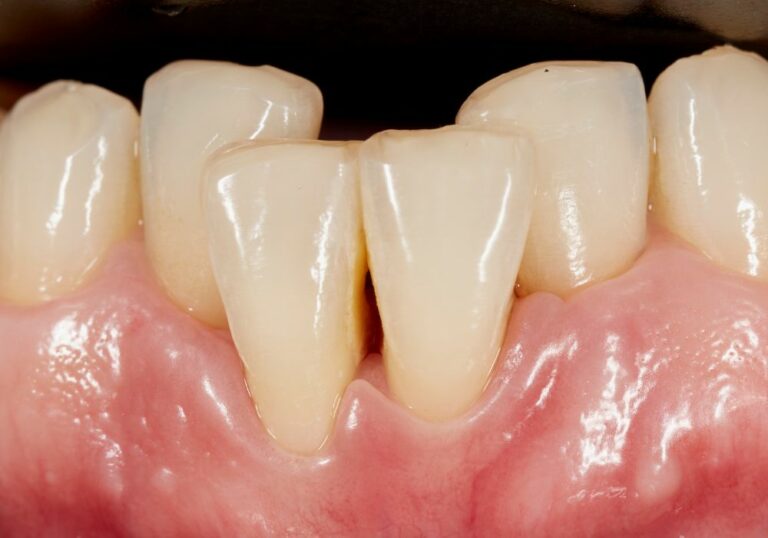 Is Tooth on Tooth Lucky? Debunking the Myth Behind This Belief