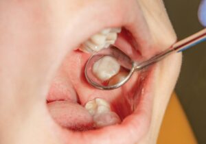 Is Molar the Last Tooth? Exploring the Human Dentition