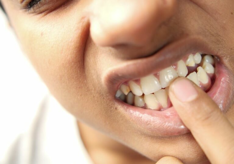 Do Teeth Fall Out at 14? Understanding the Process of Losing Baby Teeth