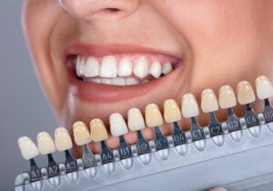 Which Teeth Shade is Best? A Guide to Choosing the Right Shade for Your ...
