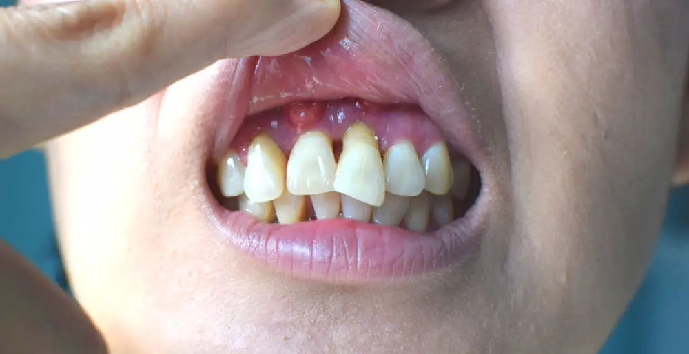 What are Adjacent Teeth? A Quick Guide to Understanding Your Teeth ...