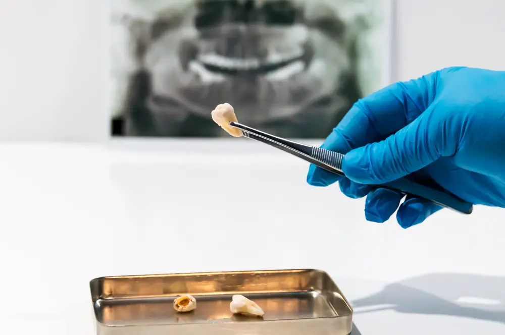 When is Wisdom Teeth Removal the Worst? A Guide to the Most Challenging ...