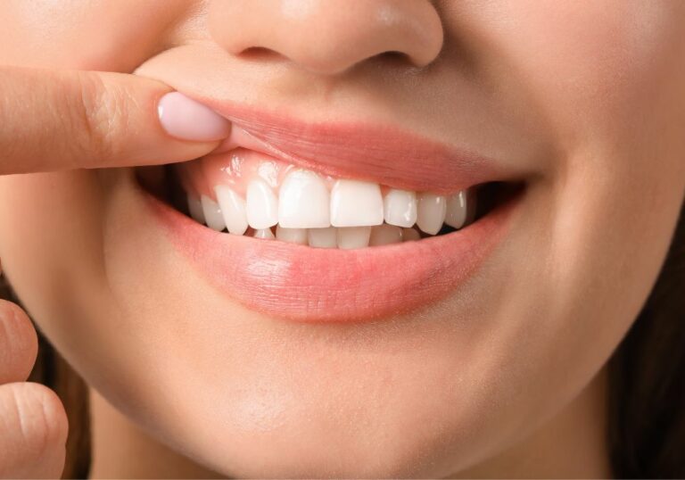 Do Gum Flaps Go Away? Understanding the Causes and Treatment Options