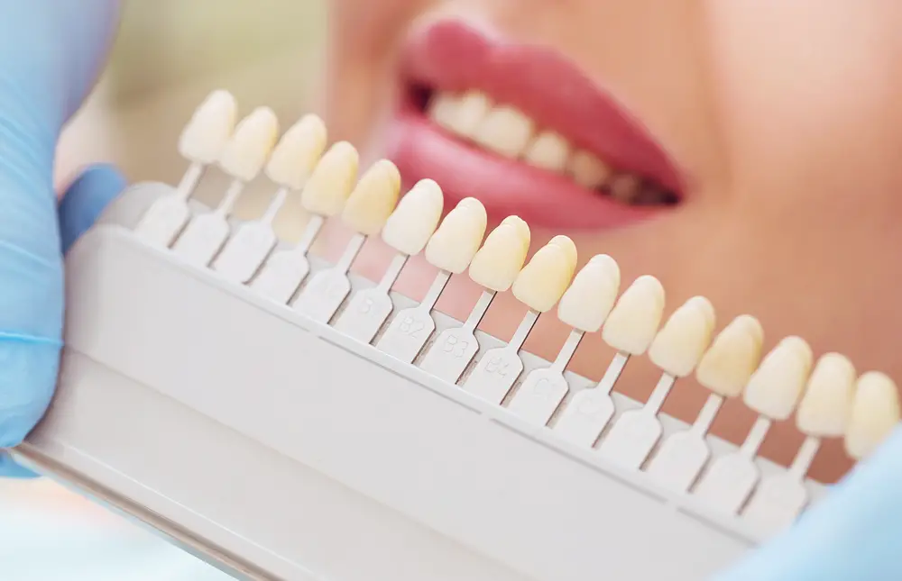 Which Teeth Shade is Best? A Guide to Choosing the Right Shade for Your ...